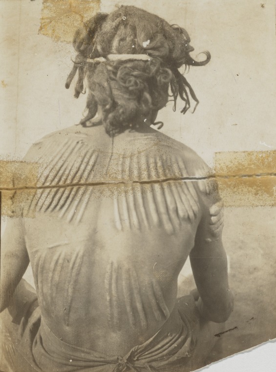 Scars on the back of an Aboriginal man at Port George IV Mission. - JPG ...
